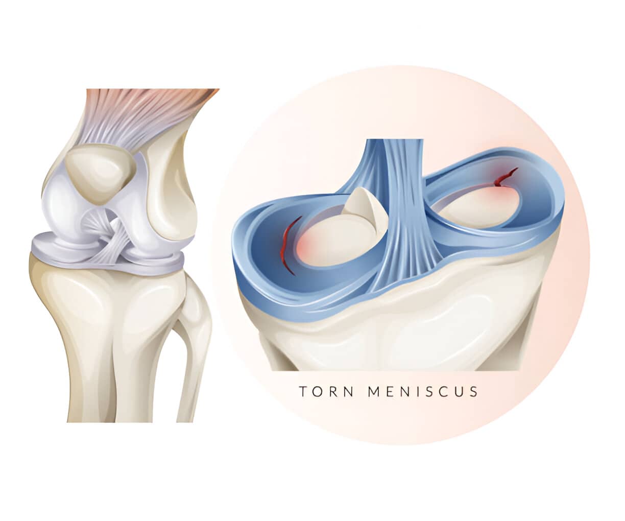 Tipos de lesiones de menisco | Causas, síntomas y tratamiento